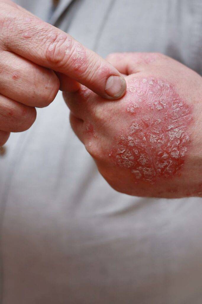 Comprehensive Eczema and Dry Skin Solutions